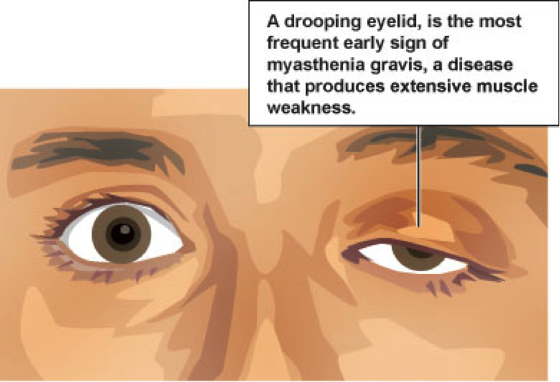 Exercise And Myasthenia Gravis Exercise And Myasthenia Gravis